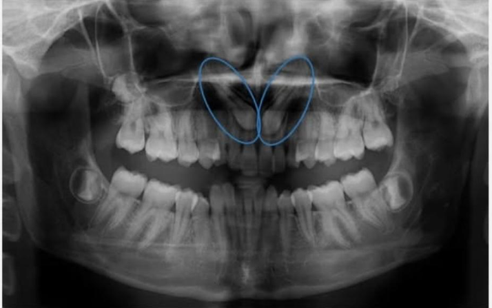 Caninos incluidos: Causas, diagnóstico y tratamiento - Clínica Dental ...