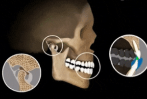ATM: Dolor en la Articulación Temporomandibular: Causas y tratamiento ...